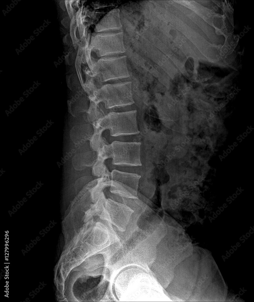 X-ray of the pelvis and spinal column ,side view Stock Photo | Adobe Stock