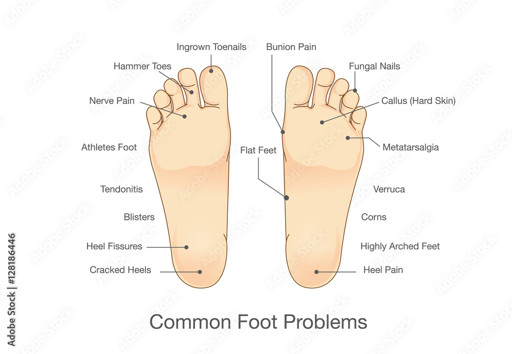 Foot Disorders