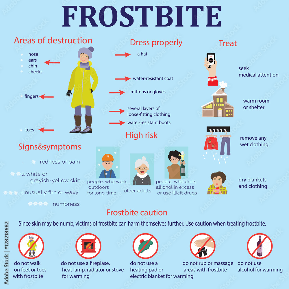 Frostbite - symptoms, risk group, treatment. infographics Stock Vector ...