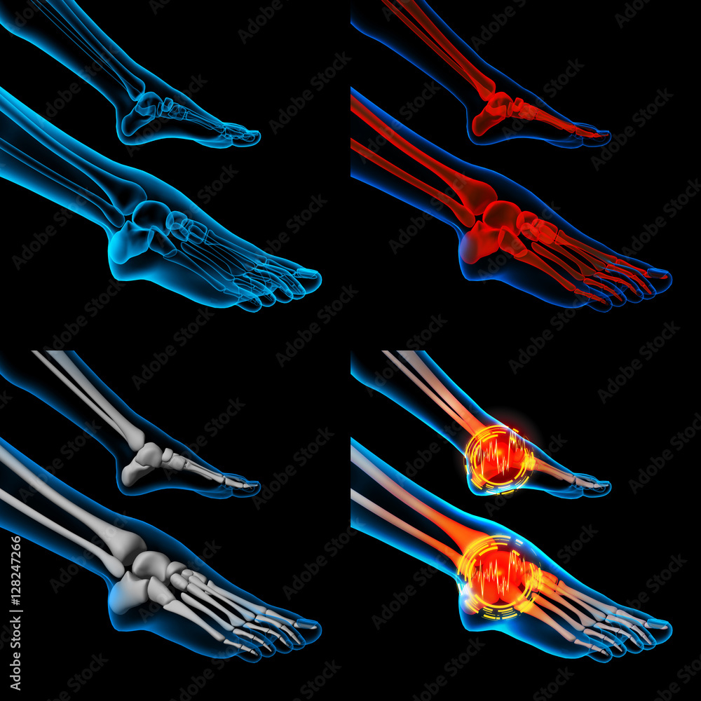 Human foot pain with the anatomy of a skeleton foot Stock Illustration ...