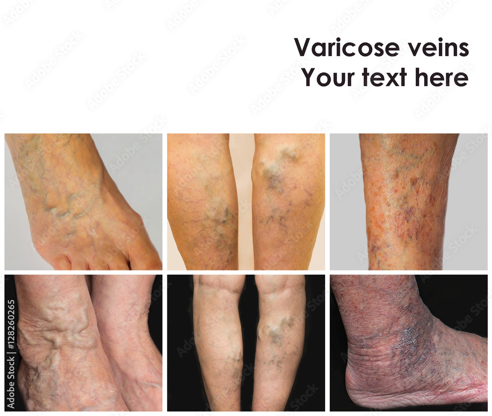 Collage from images of varicose veins Stock Photo | Adobe Stock