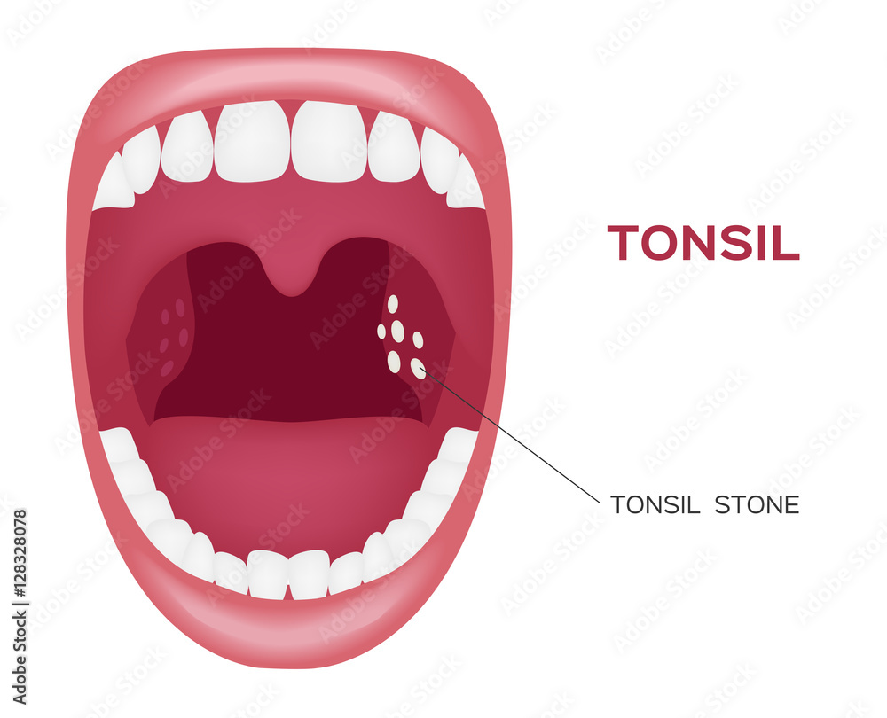 Poster normal tonsil , tonsil stone in the mouth vector – Wall Art ...