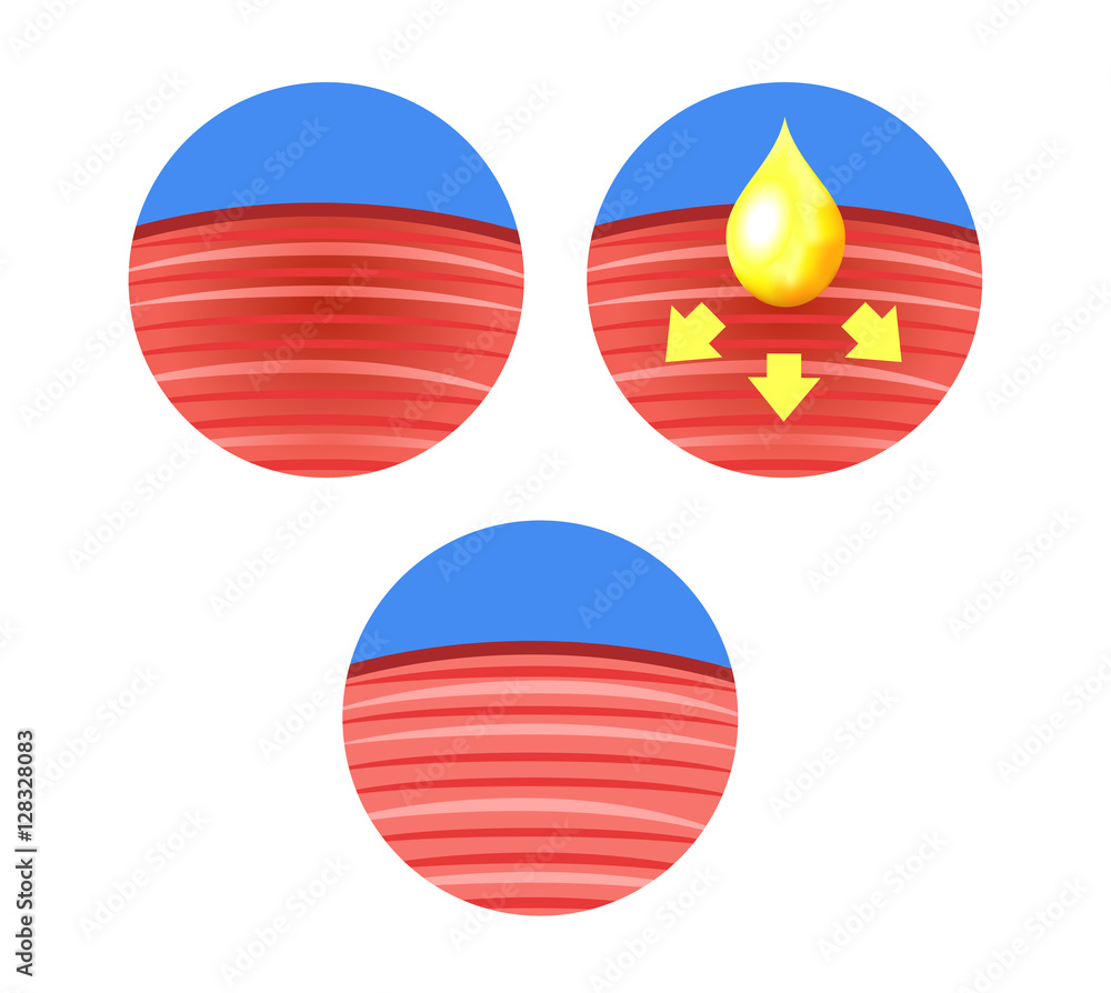 Myositis ( inflam muscle ) , a gel apply on a muscle , a normal muscle ...