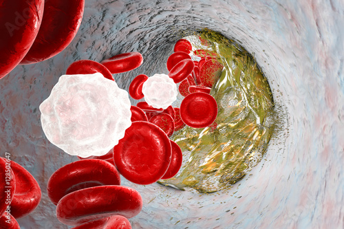 Destruction of atheroma plaque inside artery, 3D illustration ...