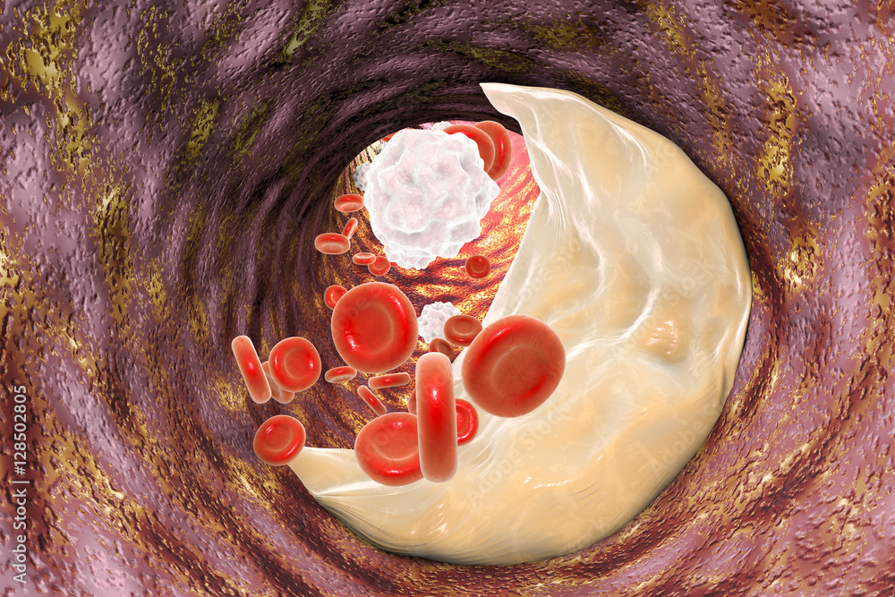 ภาพประกอบสต็อก Atheroma plaque inside artery. 3D illustration which can ...