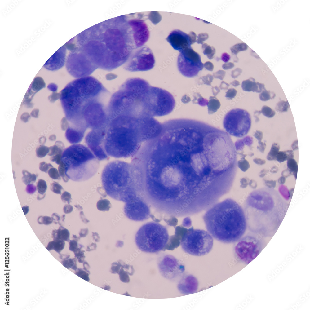 malignant cells with multiple nuclei and prominent nucleoli.Meso Stock ...