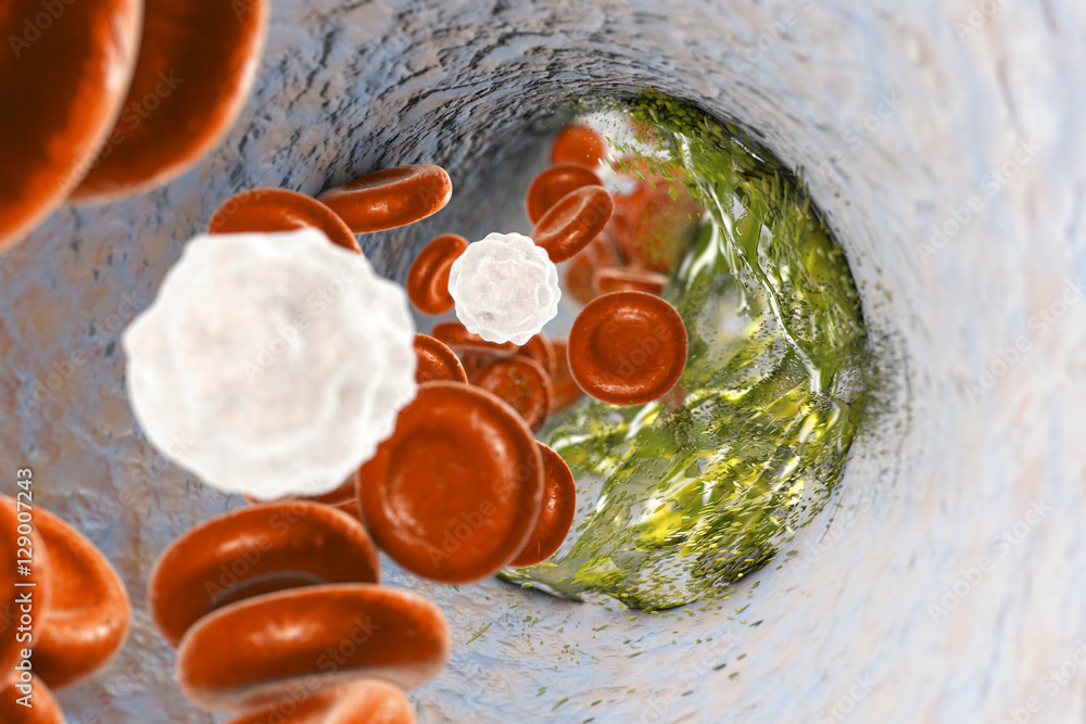 Destruction of atheroma plaque inside artery, 3D illustration ...