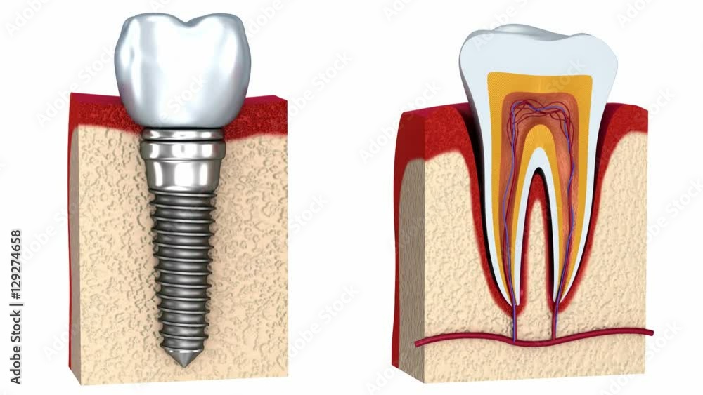 Anatomy of healthy teeth and dental implant in jaw bone. 3D animation ...