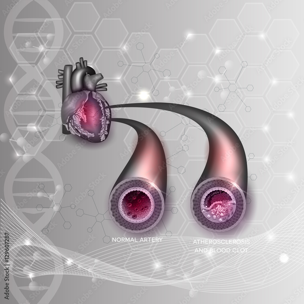 Blood clot and healthy artery. Plaque rupture and blood clot formation ...