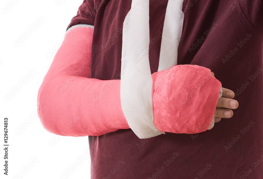 Broken arm in red plaster cast and sling Stock Photo | Adobe Stock