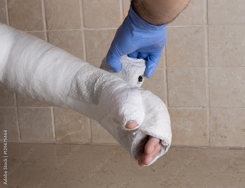 Orthopedic technician putting on a fiberglass plaster cast Stock Photo ...