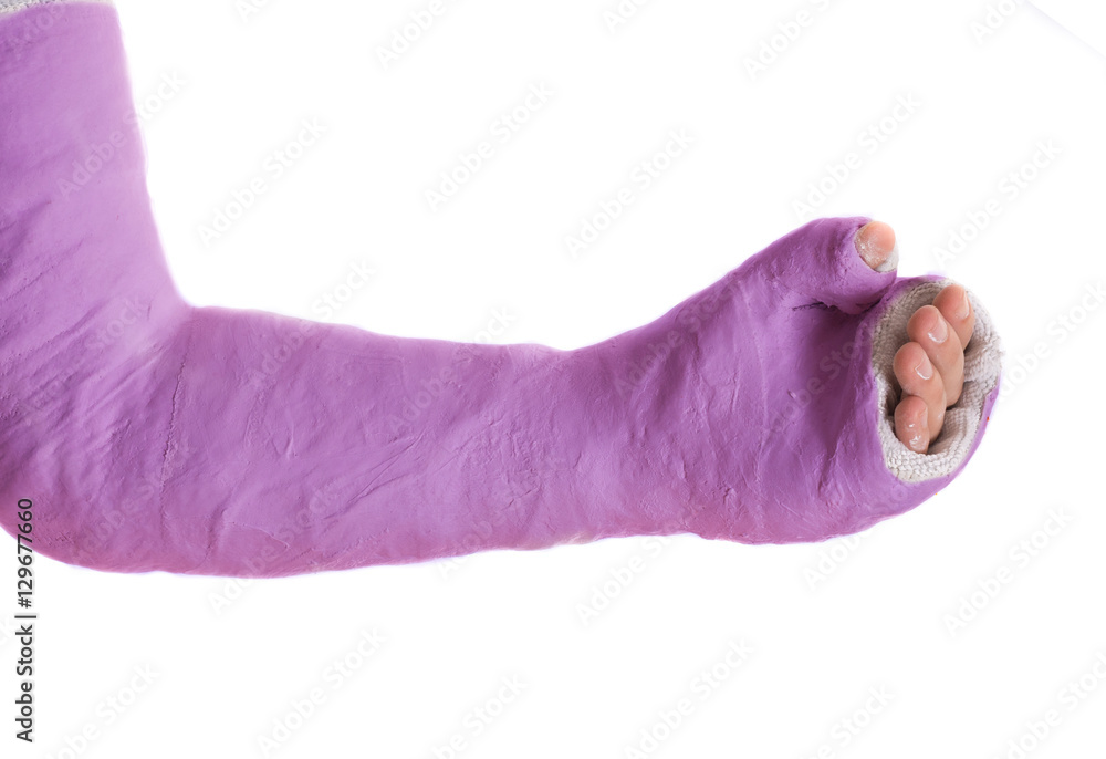 Purple long arm plaster / fiberglass cast Stock Photo | Adobe Stock
