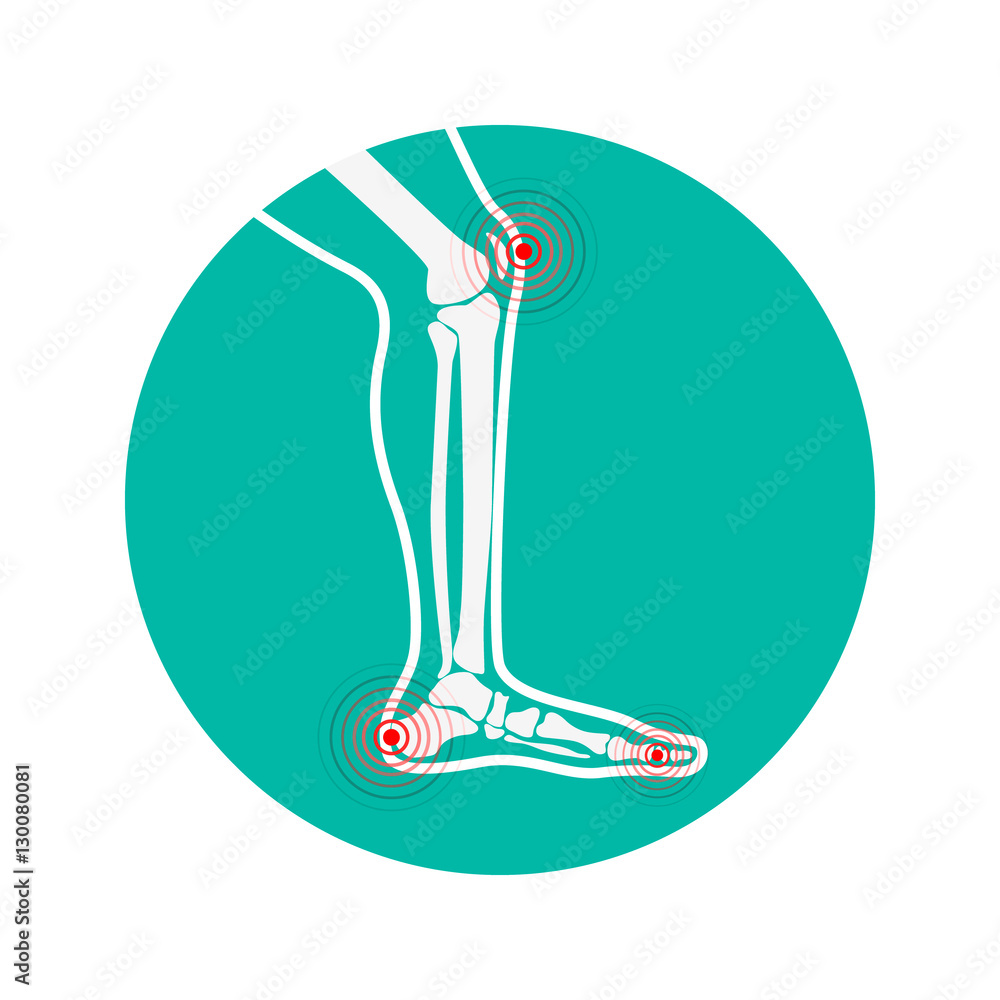 Human leg pain zones. Design elements for infographic. Vector ...