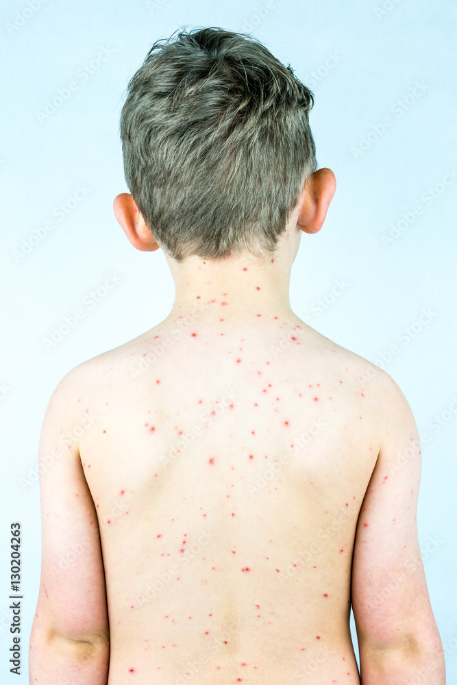 Boy with chickenpox, back with rash and blisters. Studio shot with pale ...