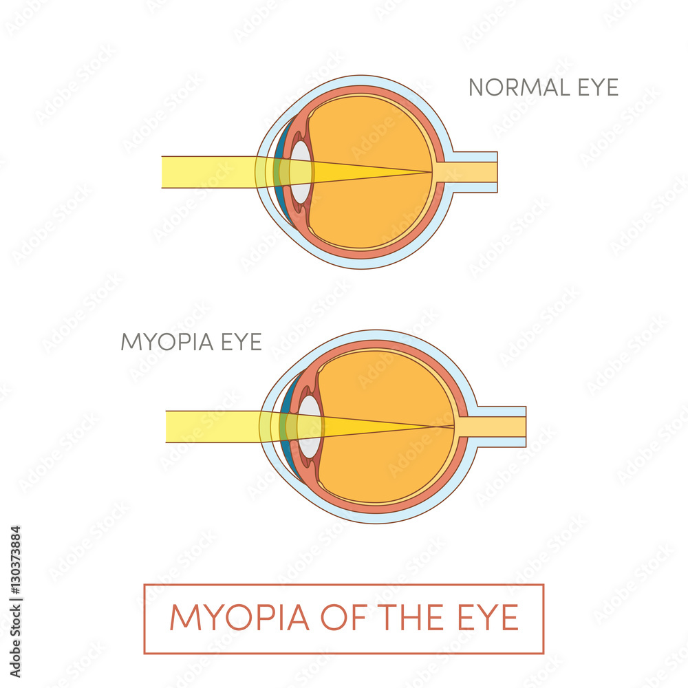 Myopia of the eye Stock Illustration | Adobe Stock