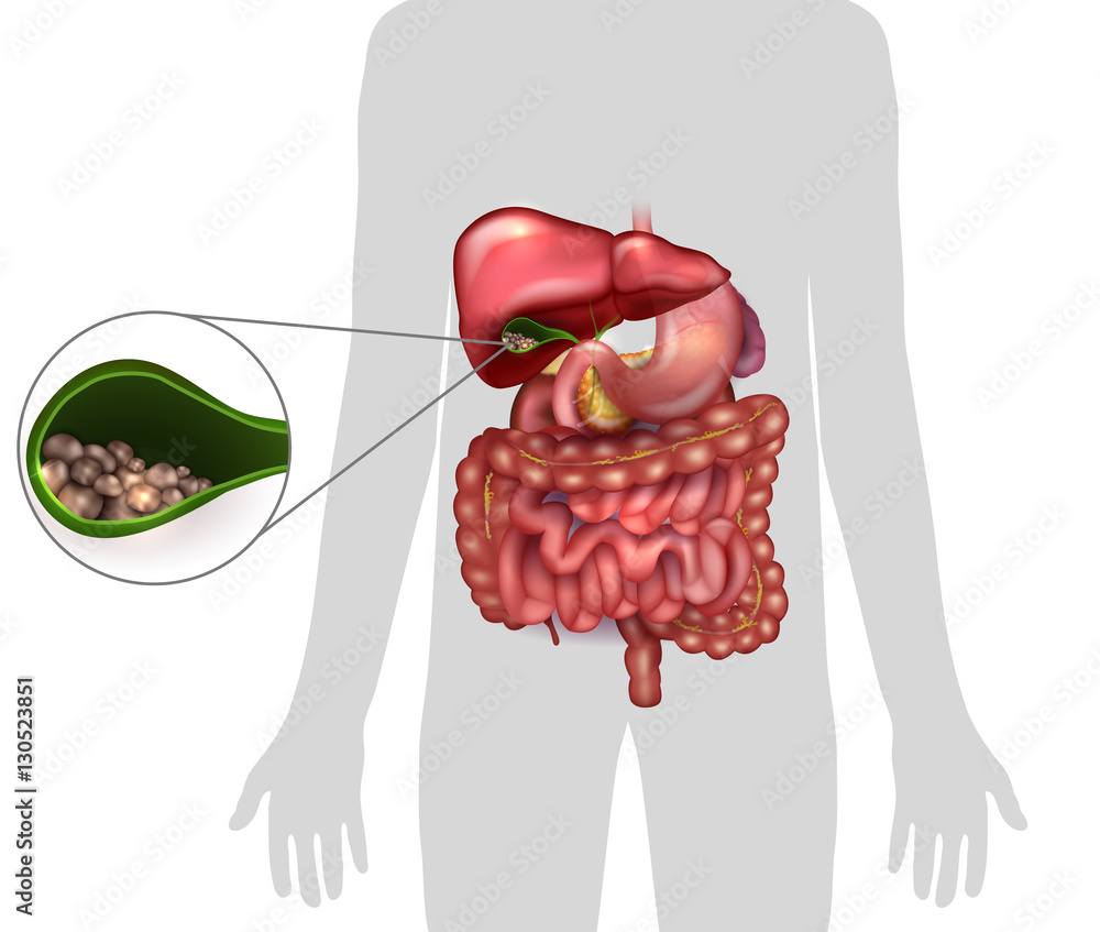 Gallstones in the Gallbladder, human silhouette and anatomy of ...