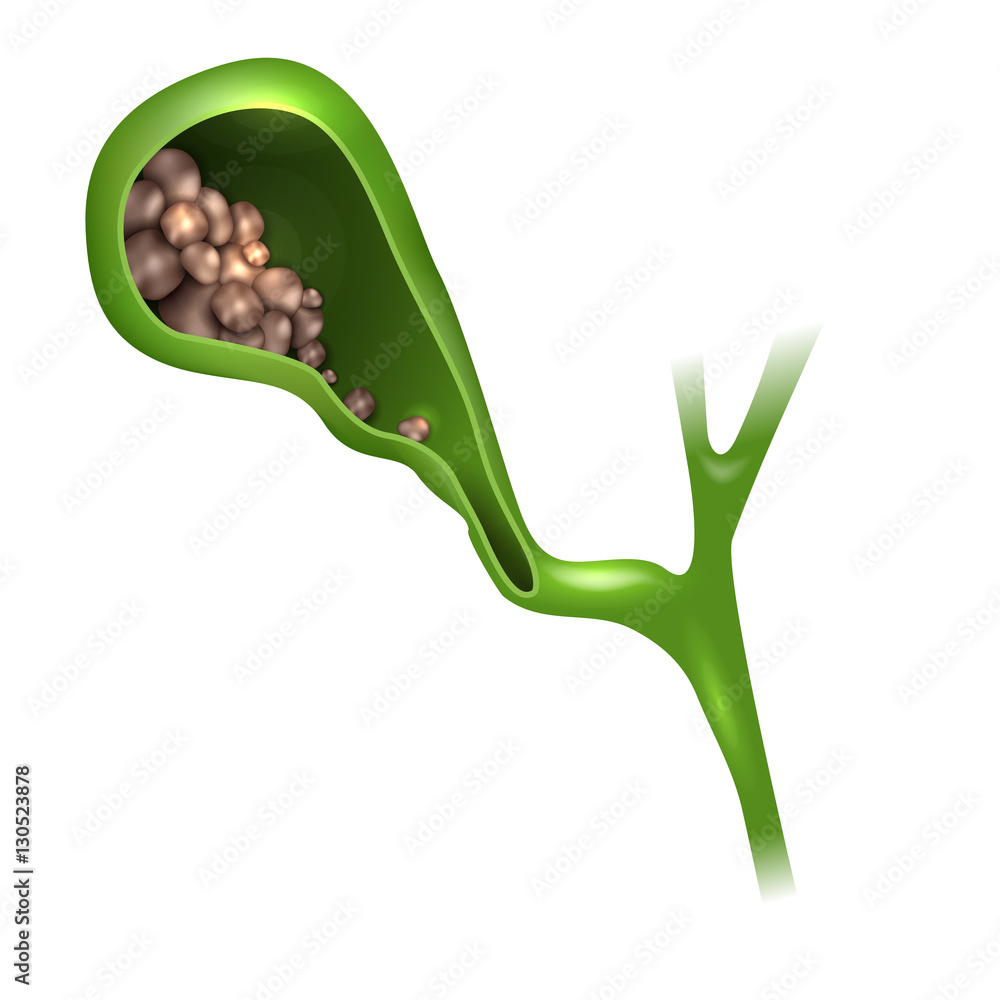 Gallstones in the Gallbladder, anatomy bright detailed illustration ...