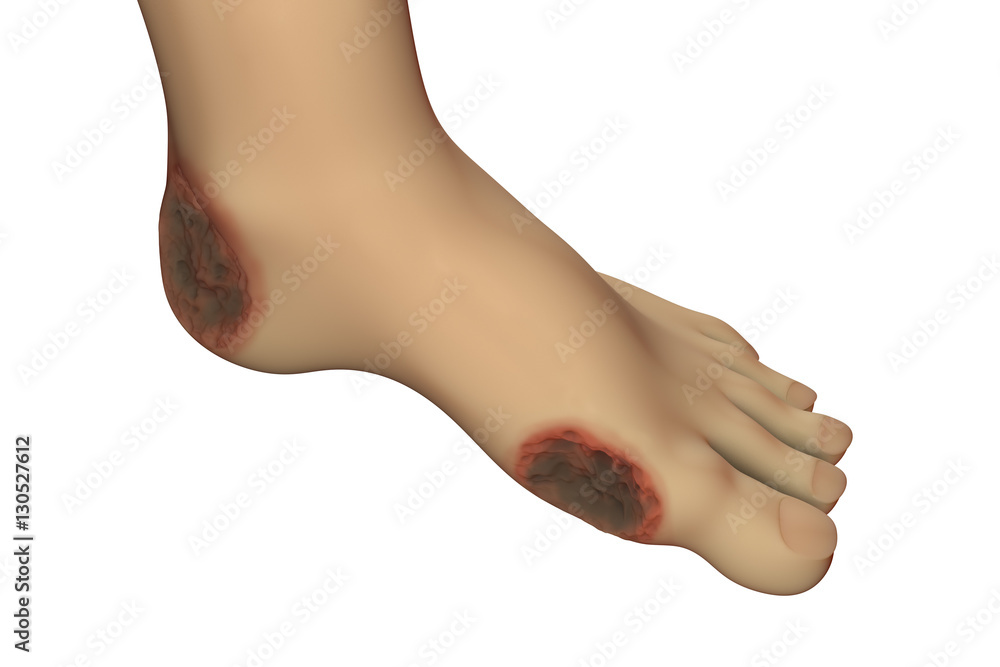 Diabetic foot ulcer, 3D illustration showing common location of ...