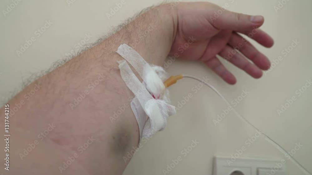 Wideo Stock: Bruise on the arm of a patient following intravenous ...