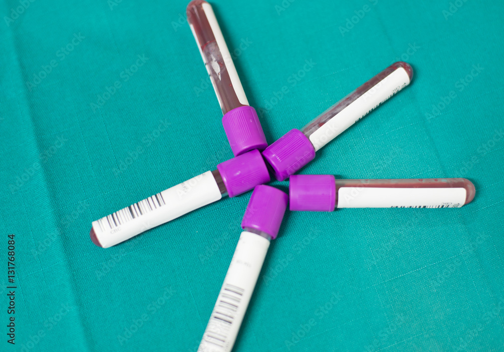 CBC Blood test tube in laboratory. Stock Photo | Adobe Stock