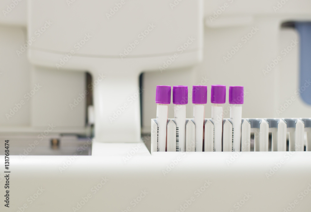 CBC Blood test tube in laboratory. Stock Photo | Adobe Stock