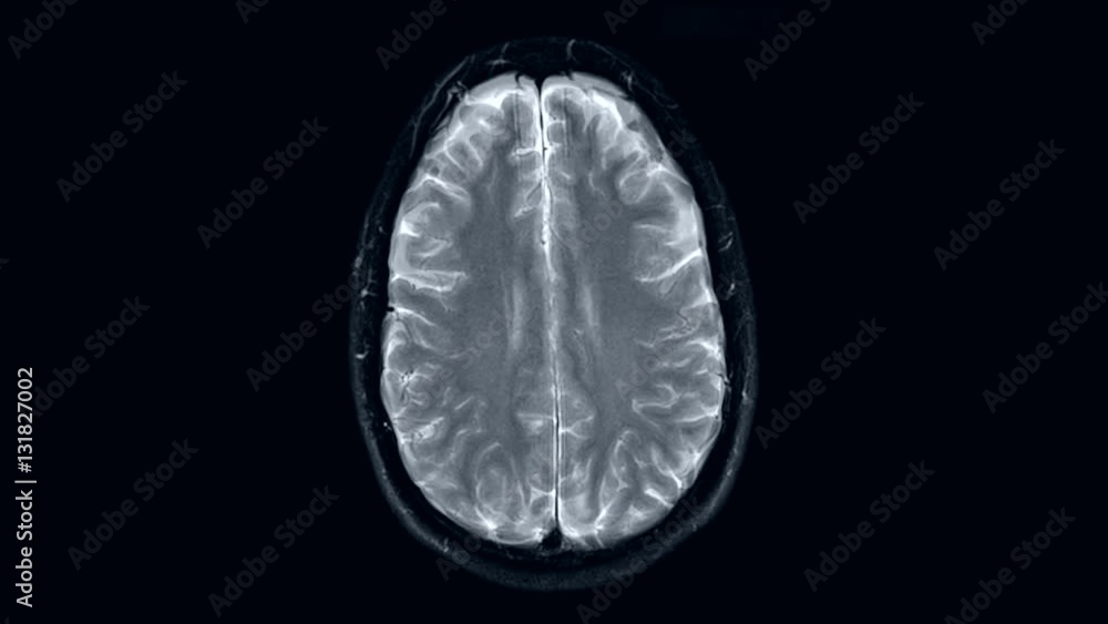 magnetic resonance imaging, MRI MRT head, top view Stock ビデオ | Adobe Stock