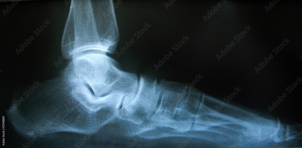 X-ray image of normal foot side. Stock Photo | Adobe Stock