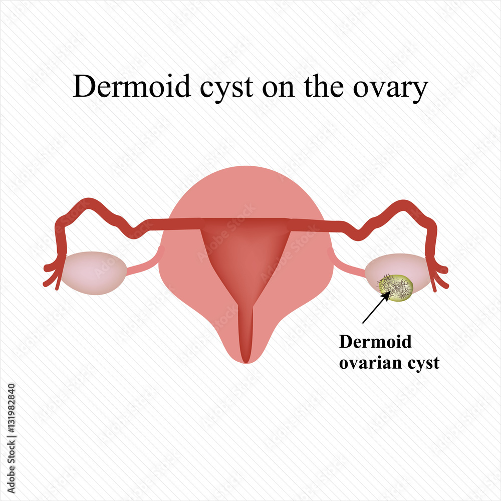 Dermoid Cyst Ovary