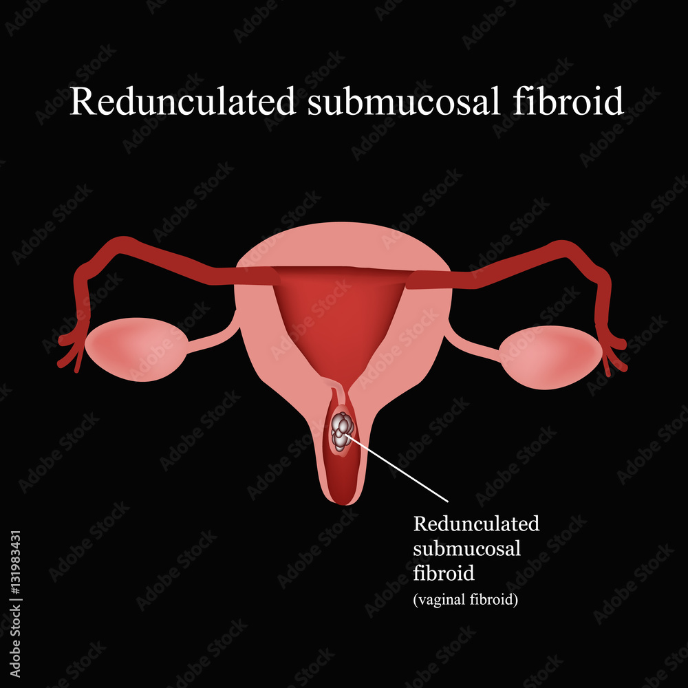 Pedunculated submucous uterine fibroids. Vaginal . Infographics. Vector ...