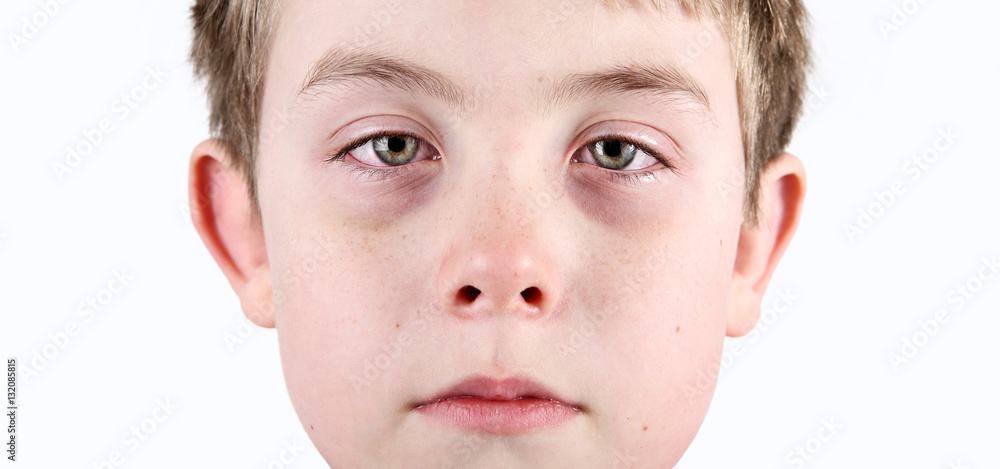 Boy with allergic shiners Stock Photo | Adobe Stock