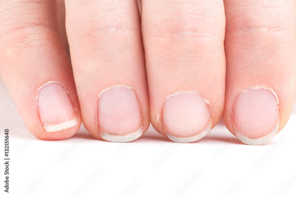 Female hand with manicure ugly Stock Photo | Adobe Stock