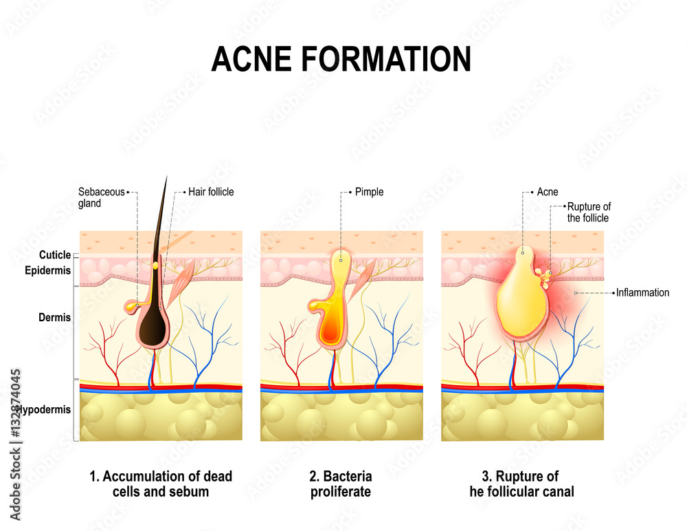 acne formation. human skin. Stock Vector | Adobe Stock
