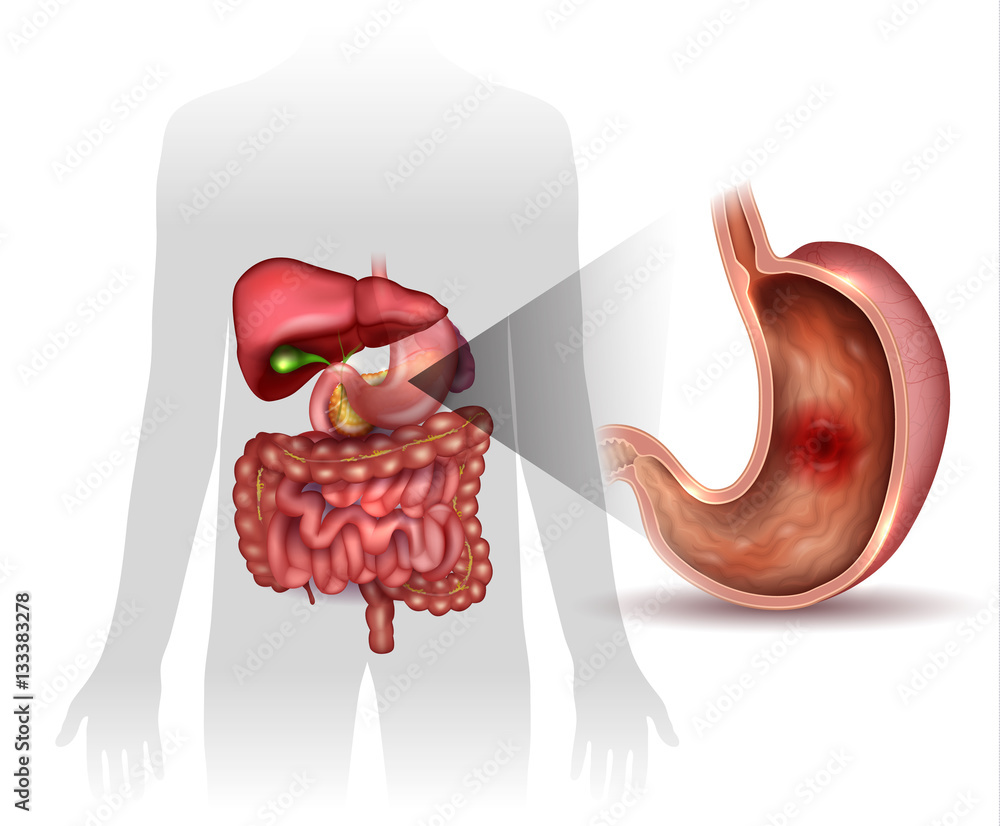 Stomach ulcer, interanal organs anatomy colorful drawing Stock Vector ...
