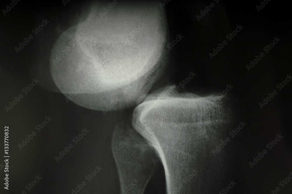 Poster X-ray, bone dislocation after accident (model-released) – Wall ...
