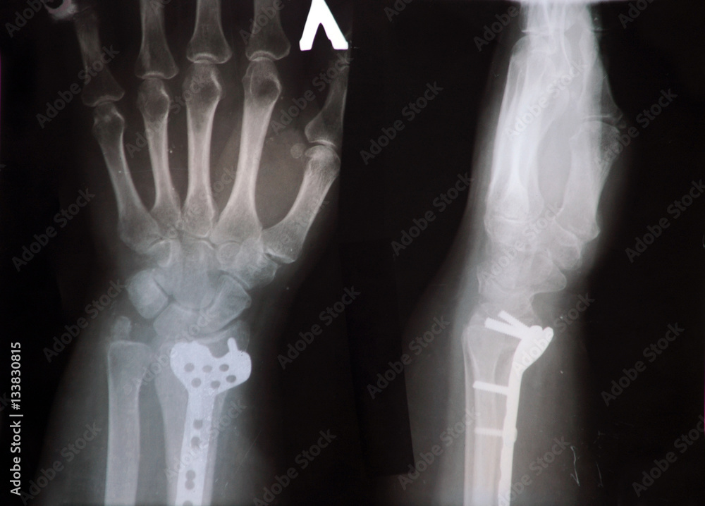 X-ray bones human hand with titanium plate Stock Photo | Adobe Stock