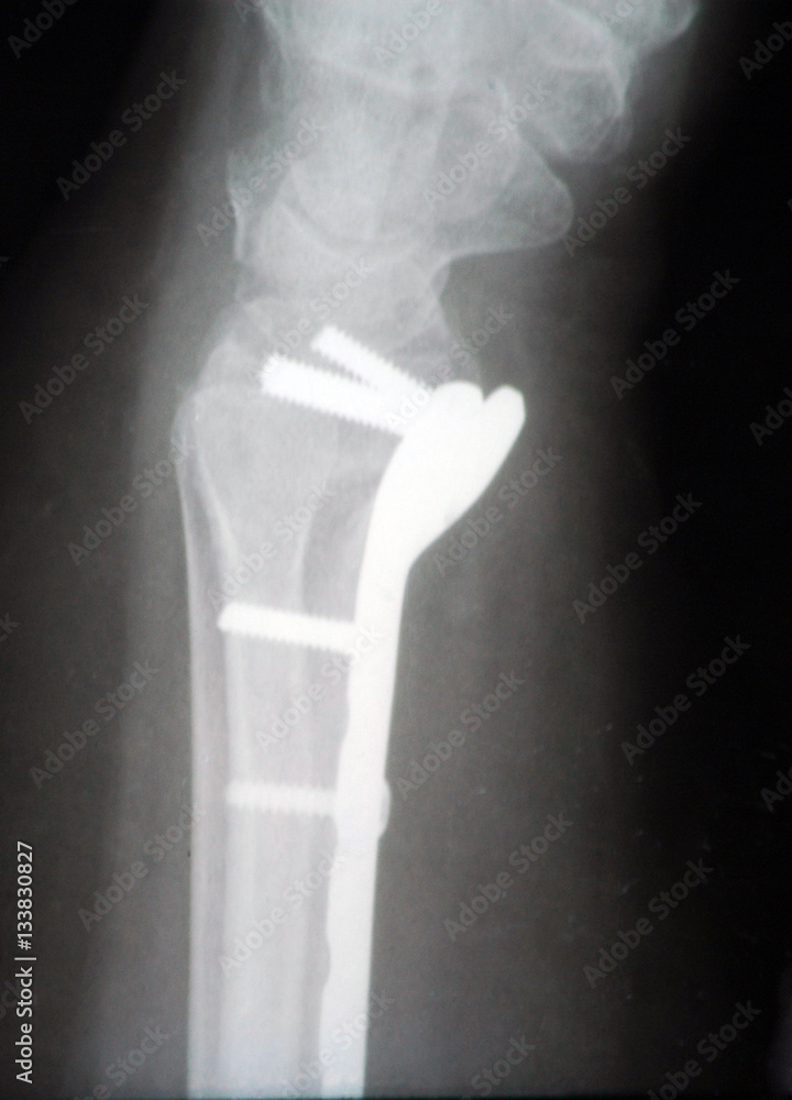 X-ray bones human hand with titanium plate Stock Photo | Adobe Stock