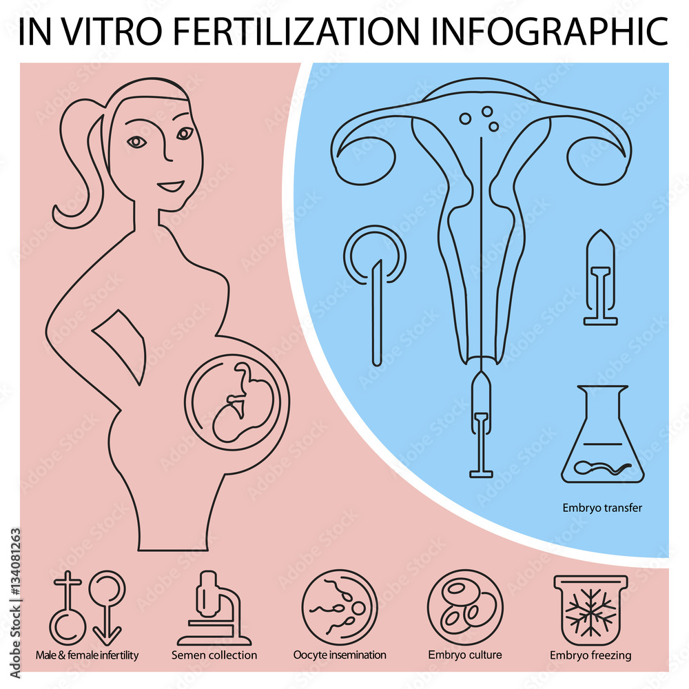 In vitro fertilization infographic. Illustration showing egg retrieval ...