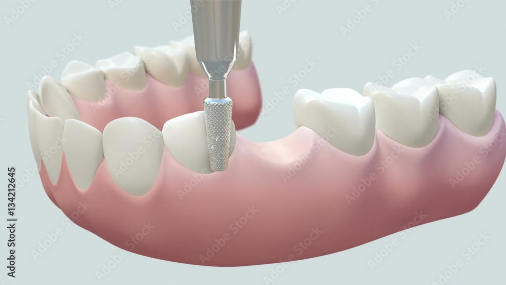 Dental Bridge White. High quality animation 3D showing the installation ...