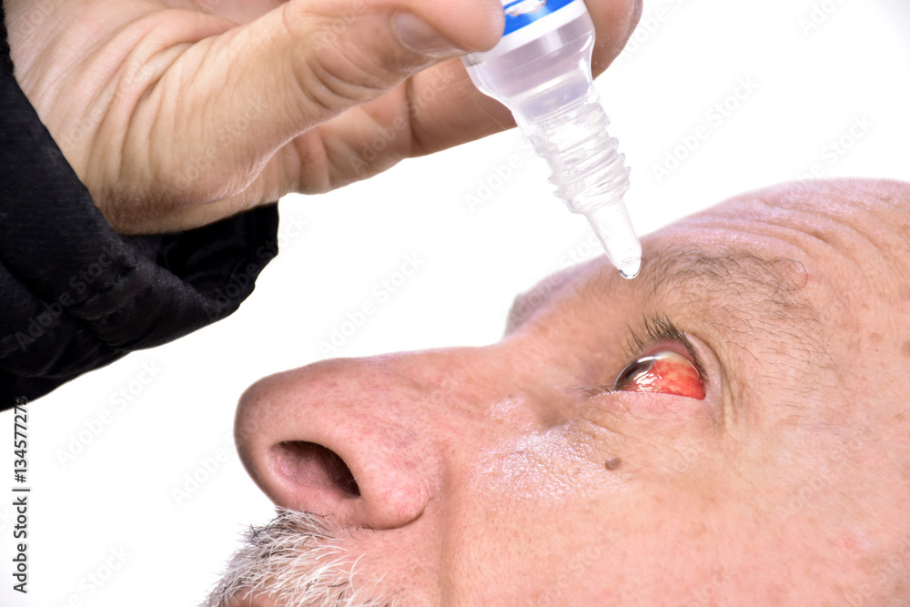 Senior man dripping a red eye with eye drops Stock Photo | Adobe Stock