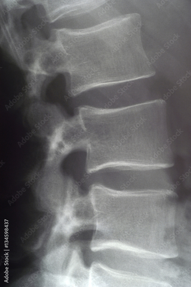 X-ray of human spinal column (model-released) Stock Photo | Adobe Stock