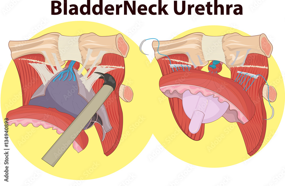 Vector illustration of Bladder neck anatomy Stock Vector | Adobe Stock