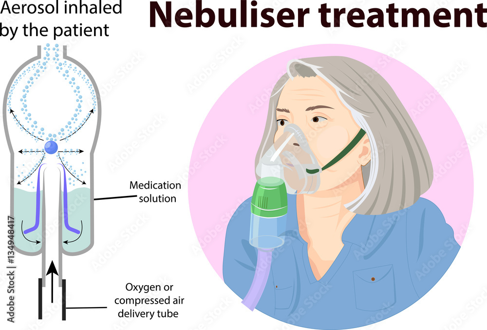 Vector illustration of nebuliser treatment anatomy Stock Vector | Adobe ...