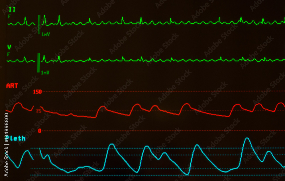 Close up of monitor with black screen showing atrial flutter on green ...