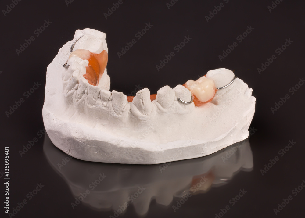 plaster cast of teeth with removable partial denture on a dark ...