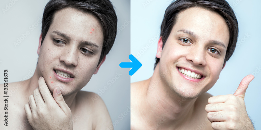 Foto de men's pimple treatment before after image, acne treatment, men ...