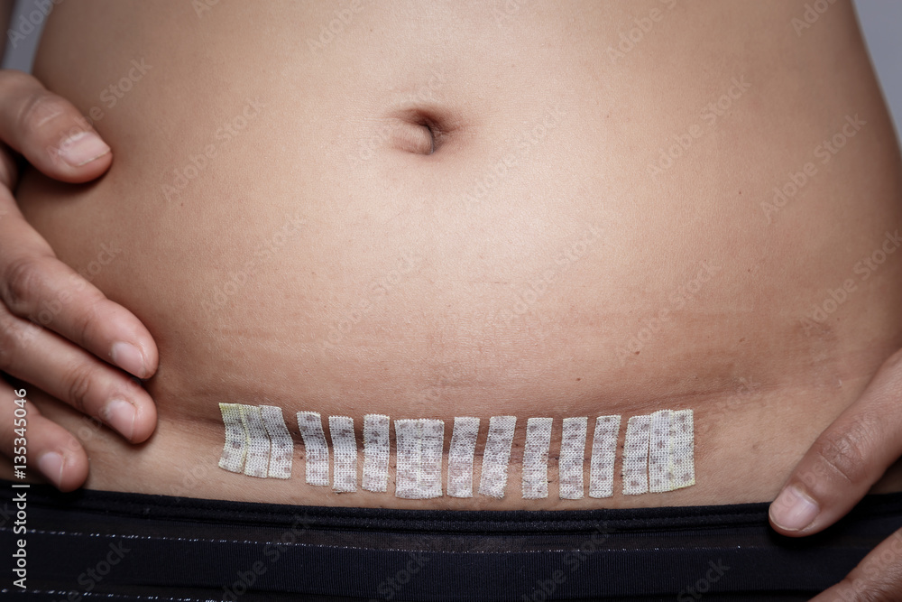 Ulcers on the skin in the abdomen after cutting off the thread. Stock ...