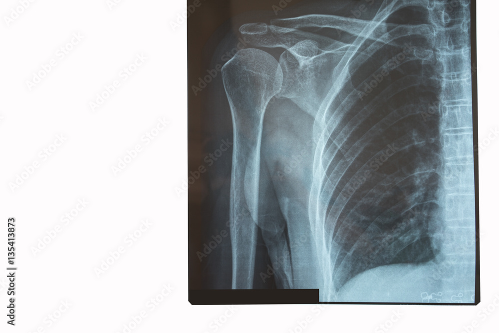 X-ray film of primary frozen shoulder or adhesive capsulitis of Stock ...