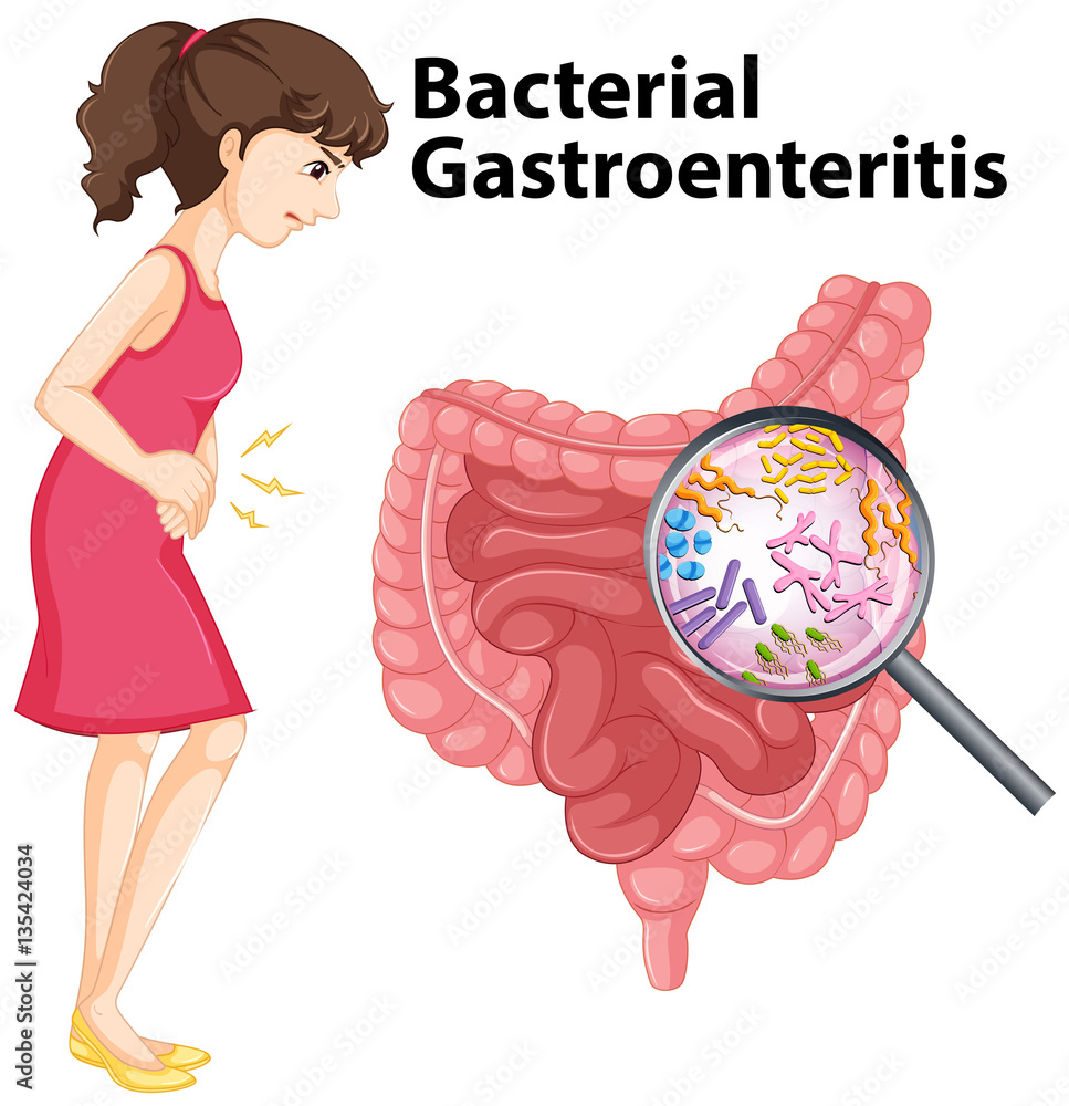 Diagram showing bacterial gastroenteritis in human Stock Vector | Adobe ...