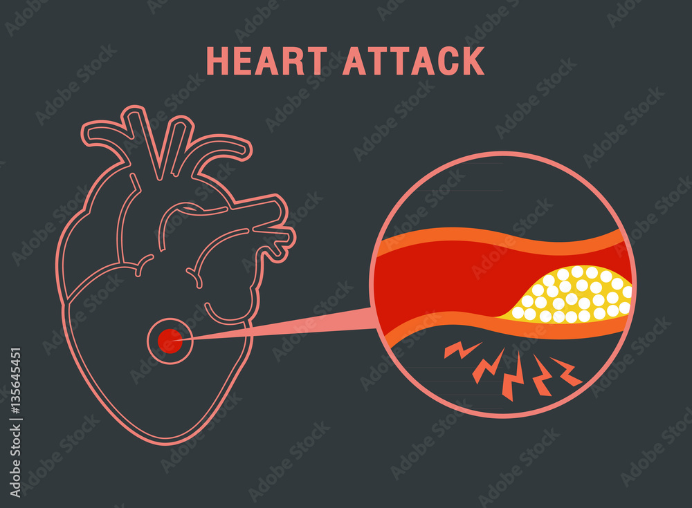 Vetor de HEART ATTACK logo vector icon design do Stock | Adobe Stock