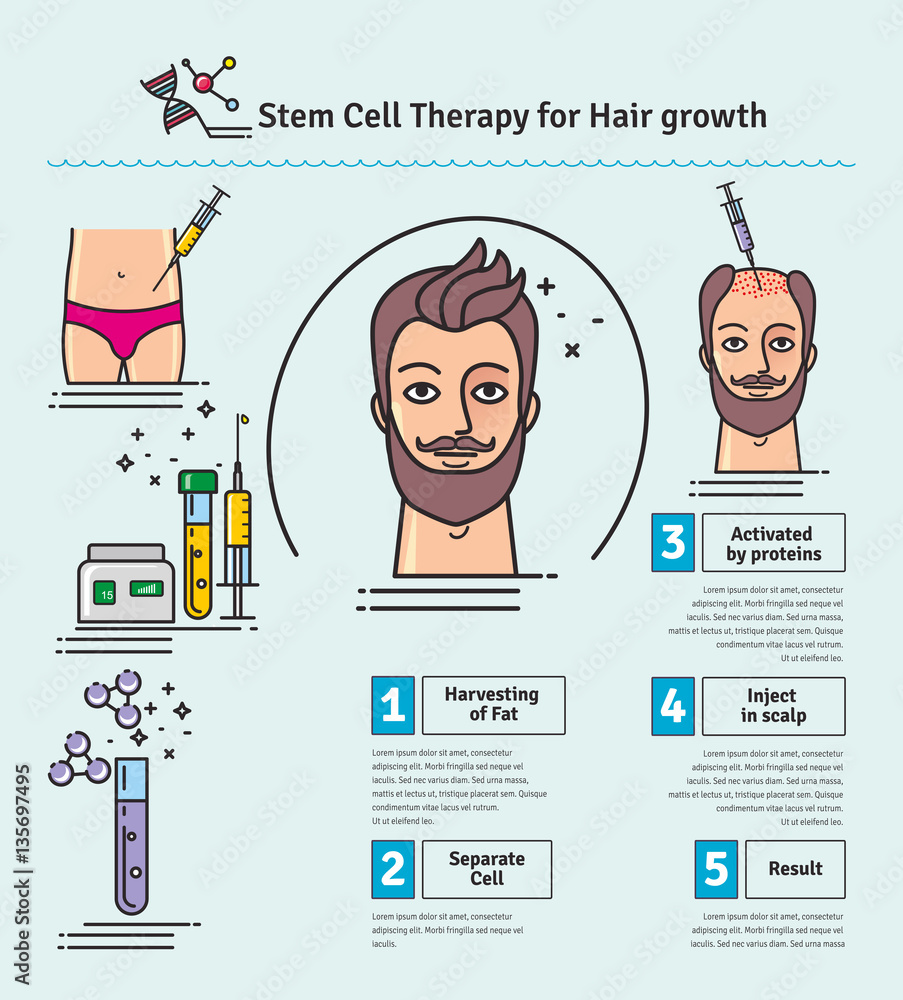 Vector Illustrated set with stem cell therapy for hair growth Stock ...
